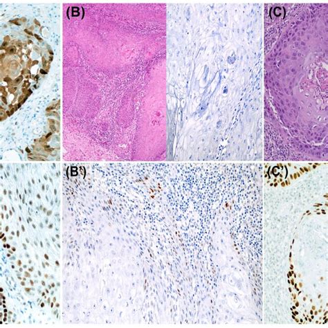 Three Discordant Cases Between P53 Immunohistochemistry Ihc And Tp53 Download Scientific