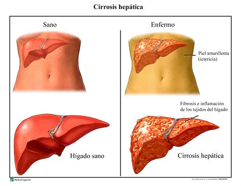 Cirrosis Alcoholica Pdf