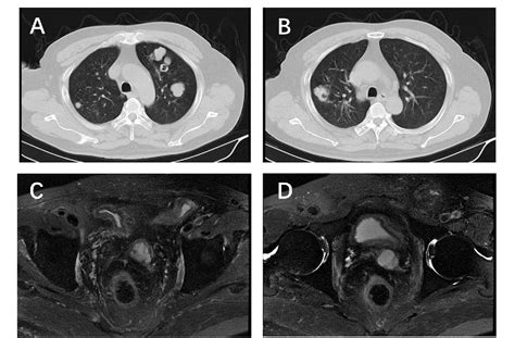 Figure 1 From An Unusual Case Of Metastatic Basal Cell Carcinoma Of The
