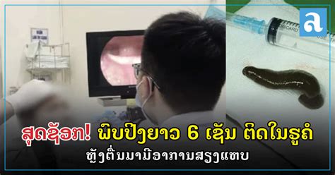 ສຸດຊັອກ ພົບປິງຍາວ 6 ເຊັນຕິດໃນຮູຄໍ ລາວໂພສຕ໌ Laopost