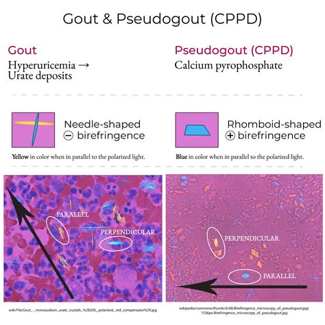 Clinical Pathology Glossary Pseudogout Aka Cppd Ditki Medical Clinical Pathology Glossary Pseudogout Aka Cppd Ditki Medical