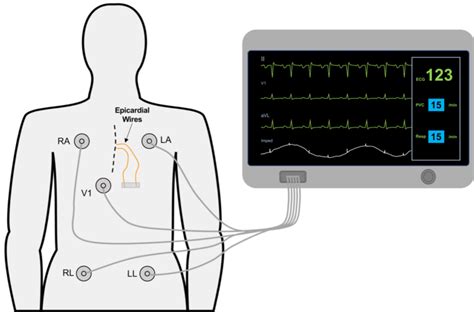 Display Of The Surface And Atrial Electrogram Atrial Electrogram Education Uw Madison