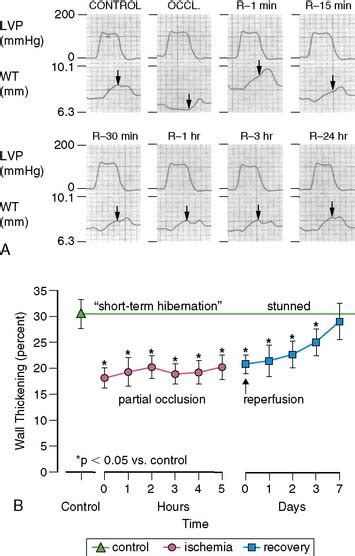 Pathophysiologic Basis Of Hibernating Myocardium Thoracic Key
