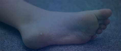 Plantar Wart Wart Removal Bespoke Health