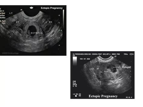 Ectopic Gestation Ppt