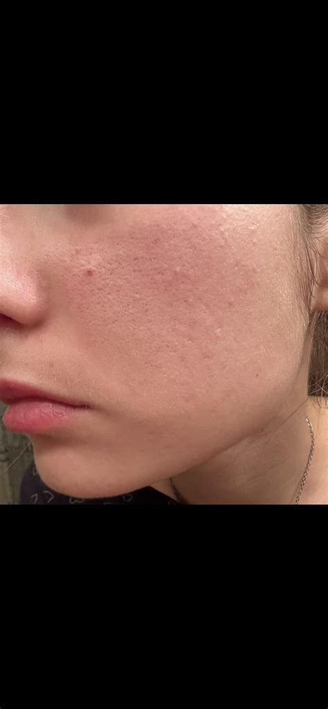 Acne Scars Large Pores Pie Any Ideas Rskincareaddiction