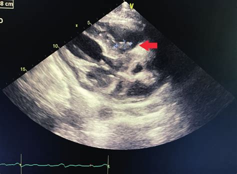 Echo Density Visualized In The Right Ventricle RV Vegetation Is