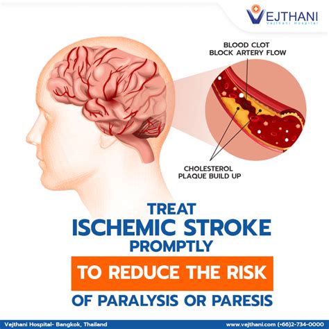 Ischemic Stroke Brain