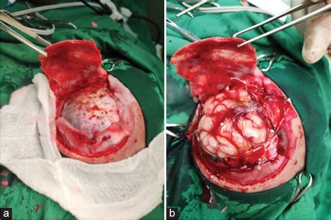 Surgical Neurology International