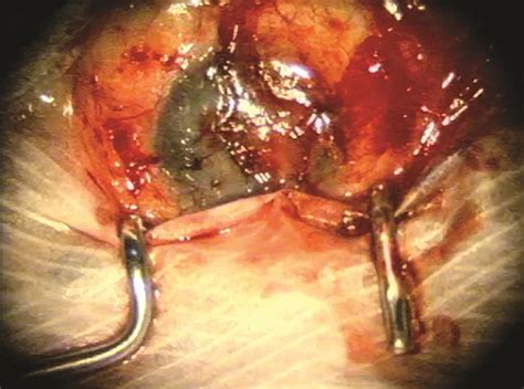 Persistent Epithelial Defect American Academy Of Ophthalmology
