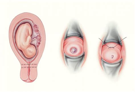 Abnormalities Of The Uterus In Pregnancy Types Risks And Treatment
