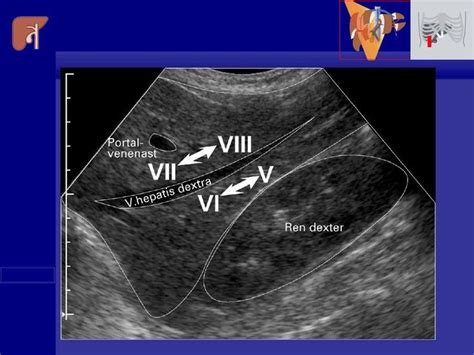 Lebersegmente Sono Ultrasonido Radiología Anatomia Y Fisiologia Humana