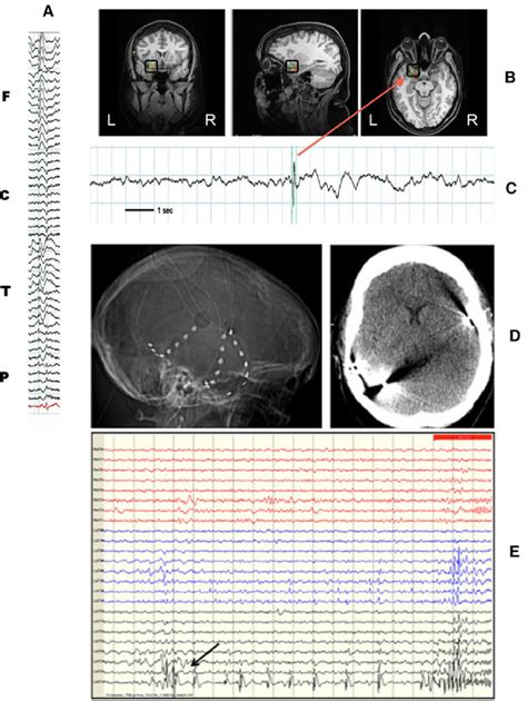Meg Sensor Data Of An Interictal Spike Identified By The Samg2