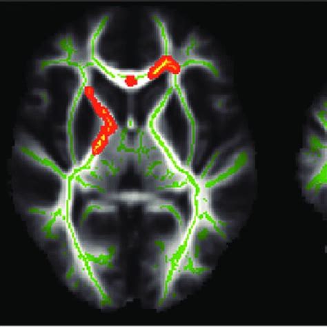 Results From Tract Based Spatial Statistics Analysis Showing Clusters