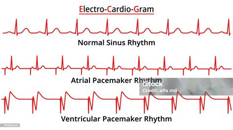 Set Of Ecg Common Abnormalities Atrial Vs Ventricular Pacemaker Rhythm Single Chamber Stock