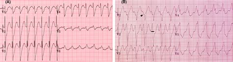 A Svt With Left Bundle Branch Block Morphology There Is A Narrow Download Scientific Diagram