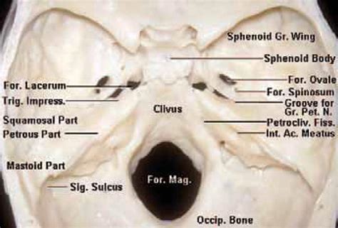 Internal Acoustic Meatus Temporal Bone
