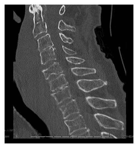 Ct Soft Tissue Of The Neck Without Contrast Showing Prevertebral Soft Download Scientific