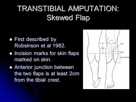 Transtibial Surgical Technique Ppt Video Online Download