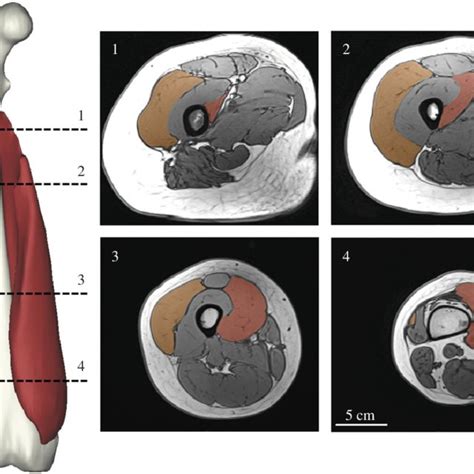 Individual Example Of Muscle Segmentation And Muscle Volume