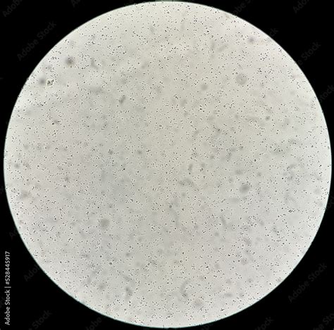 Semen Analysis Under Microscopy Showing Pyospermia Or Leukocytospermia Sperm Analysis Stock