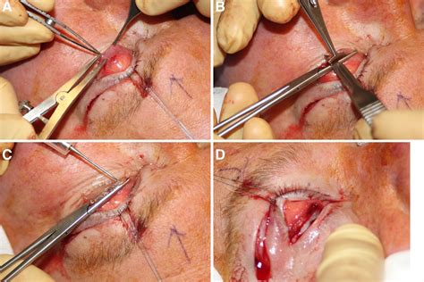 Efficacy Of Müllers Muscle Conjunctival Resection With Or W