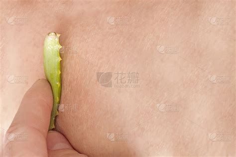 护肤品芦荟用于消除腿部皮肤的炎症和肿胀