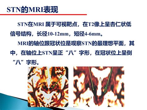 丘脑底核电刺激术（stn Dbs）治疗帕金森病 脑医汇 神外资讯 神介资讯