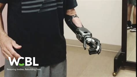 External Prosthetic Device At Tanner Troy Blog