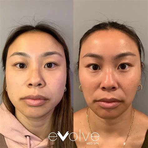 Masseter Botox Before And After Evolve Med Spa