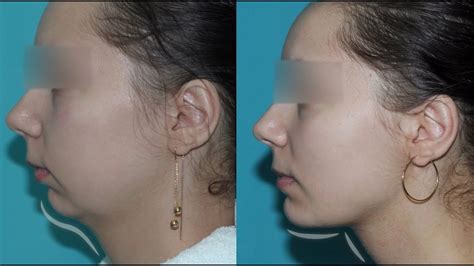 Как убрать второй ПОДБОРОДОК и БРЫЛИ Подтяжка ЛИЦА нитями Youtube