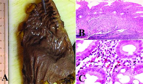 A Macroscopic Aspect Showing Granular Appearance Of The Mucosa With Download Scientific