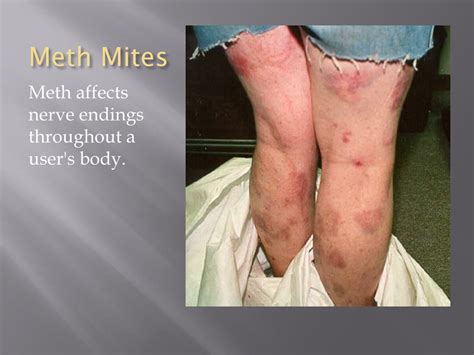 Meth Sores Bugs And Mites Explained Whlfs