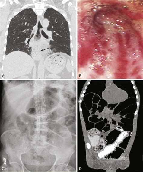 Clinical Features And Treatment Of Scleroderma Musculoskeletal Key
