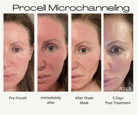 Procell Therapies The London Skin Clinic