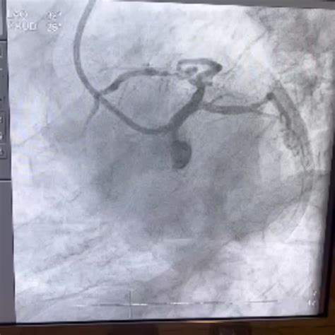 [video] Saeed Amiripouya On Linkedin Pci Lad Large Diagonal Tap Technique