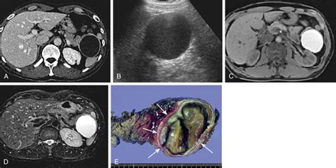 Focal Splenic Lesions Radiology Key