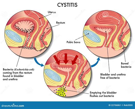 Cystitis Cartoons Illustrations And Vector Stock Images 2210 Pictures