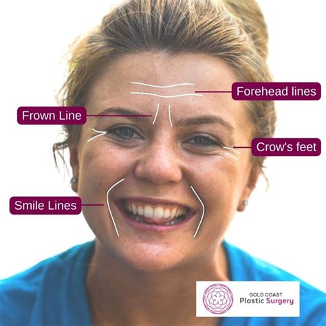 Understanding The Forehead Muscles Facial Plastic Surgery Institute🆎 Understanding The Forehead Muscles Facial Plastic Surgery Institute🆎