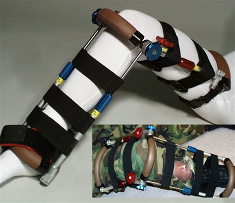 Reel Splint Immobilizer Traction Splint Medic Depot
