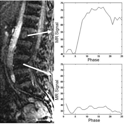 Characterizing Hypervascular And Hypovascular Metastases And Normal