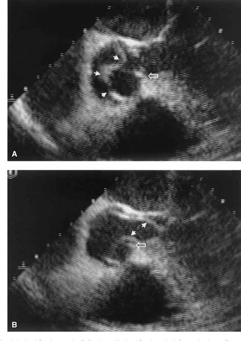Figure 1 From Proximal Prolapse Of Aortic Intimal Flap A Rare