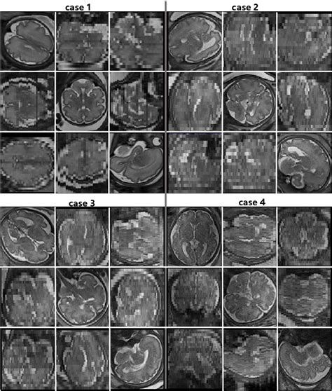 Figure 2 From Self Supervised Fetal Mri 3d Reconstruction Based On Radiation Diffusion