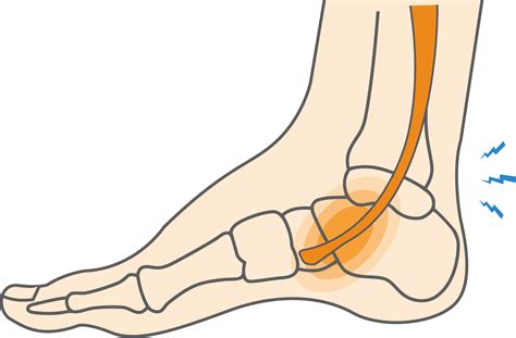 Posterior Tibial Tendonitis Symptoms Causes Treatments 57 Off