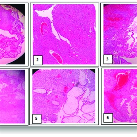 1 6 Microscopic Appearance Of Poc From Aborted Women Photomicrograph