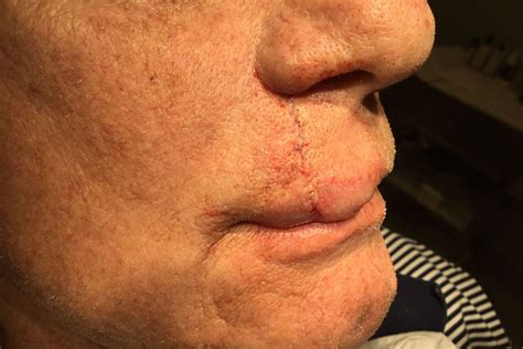 Mohs Surgery Procedure Gallery Baucom And Mina Derm Surgery Llc