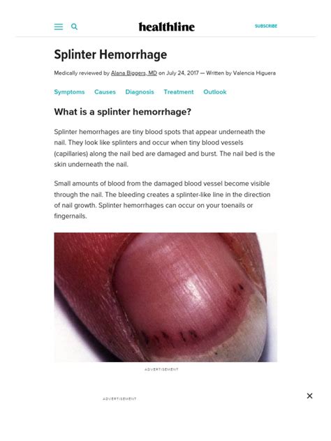 Splinter Hemorrhages Symptoms Causes And Treatments Pdf Pdf Nail Anatomy Bleeding