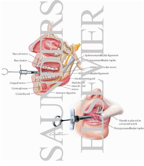 Mandibular Injections Inferior Alveolar Nerve Block