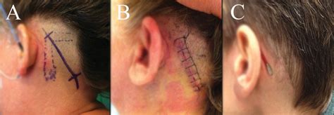A Multilayered Technique For Repair Of The Suboccipital Retrosigmoid