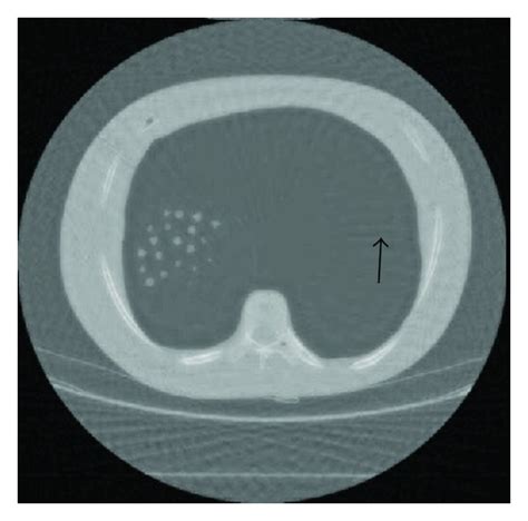 The Reconstruction Results Of The Nodule Phantom Using Projections Download Scientific